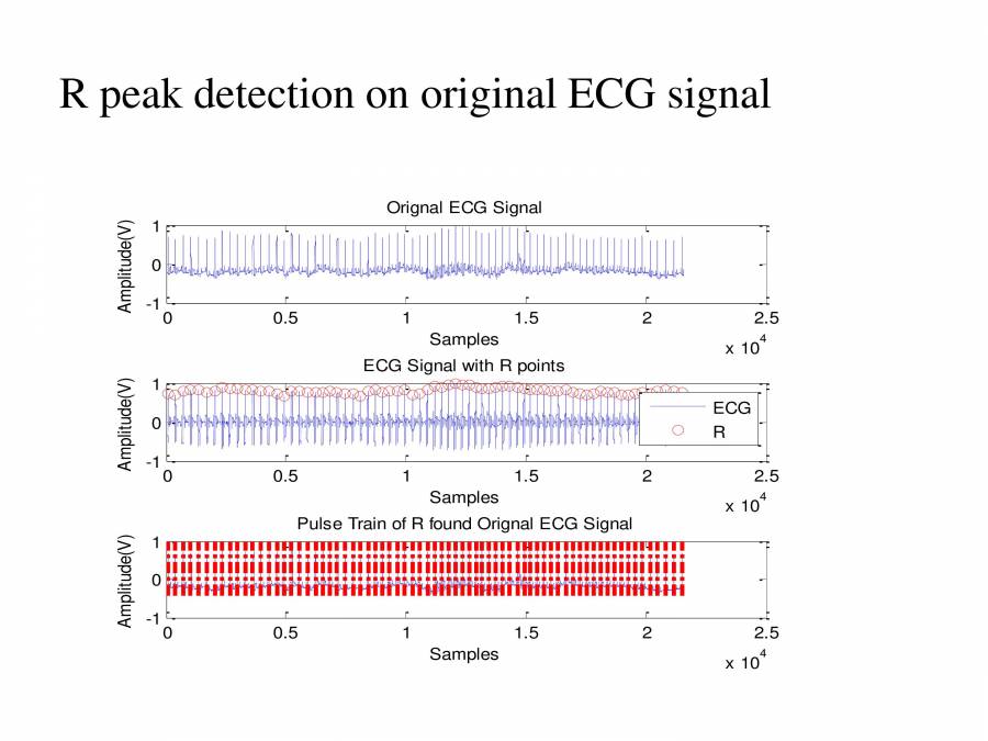 Optimal ECG Data Compression For An E-Health Transmission System - PowerPoint Slides - LearnPick ...