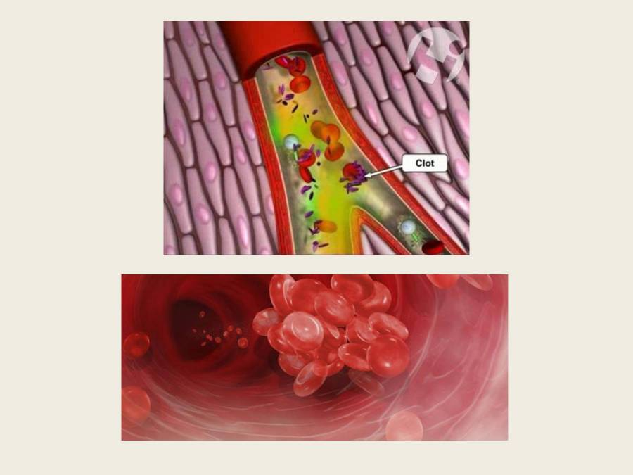 Bleeding And Clotting Disorders - PowerPoint Slides - LearnPick India